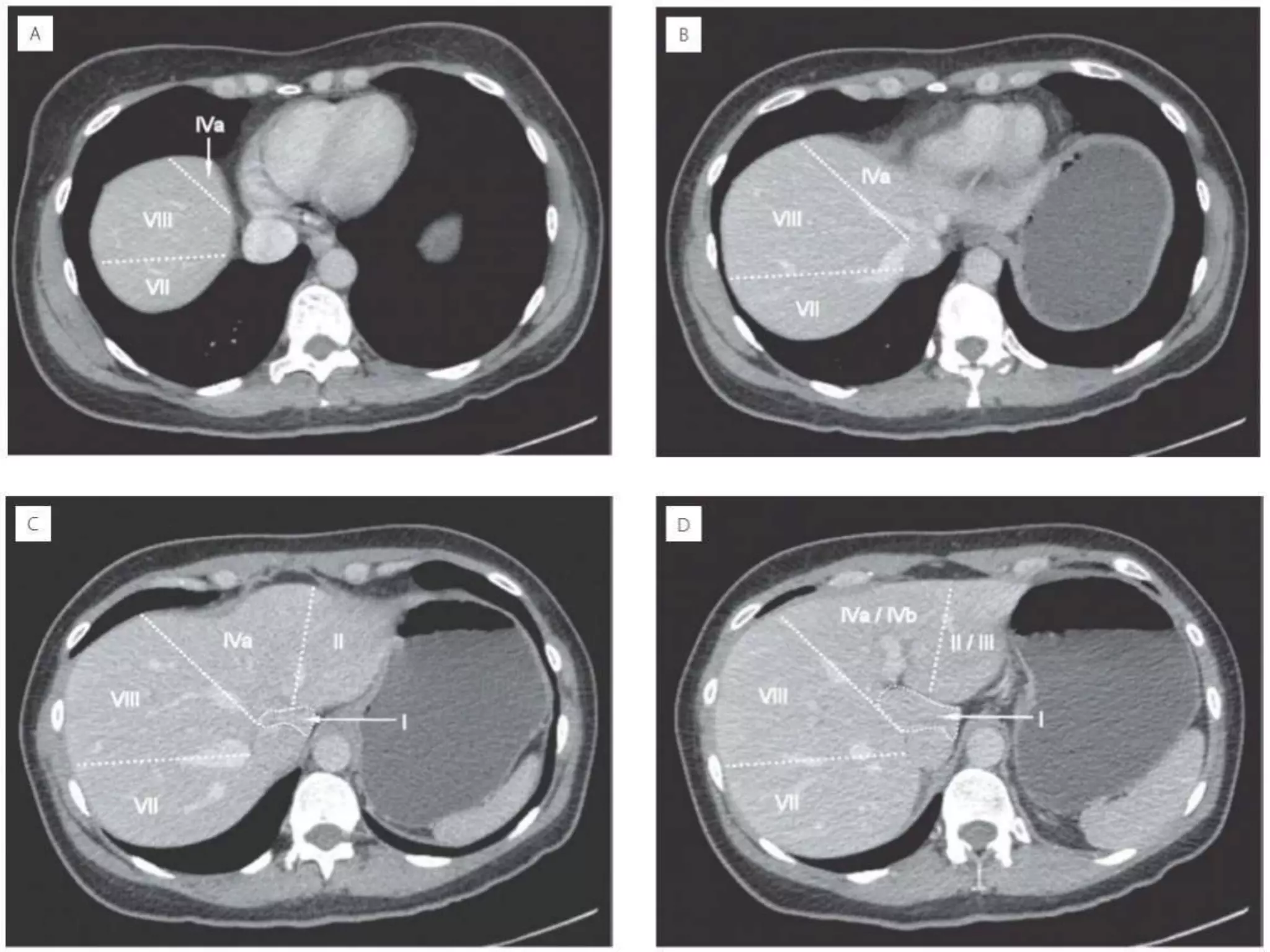 radiological anatomy of liver segments (1).pptx