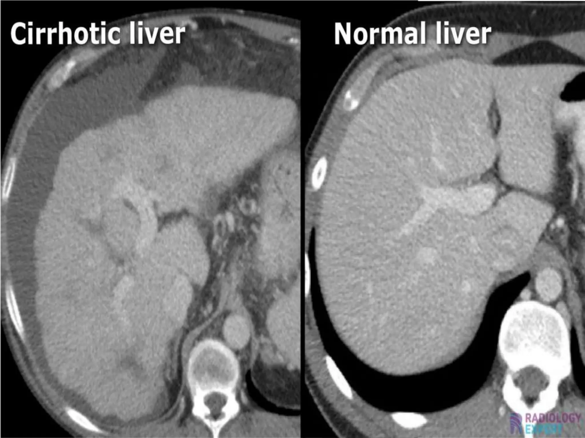 radiological anatomy of liver segments (1).pptx