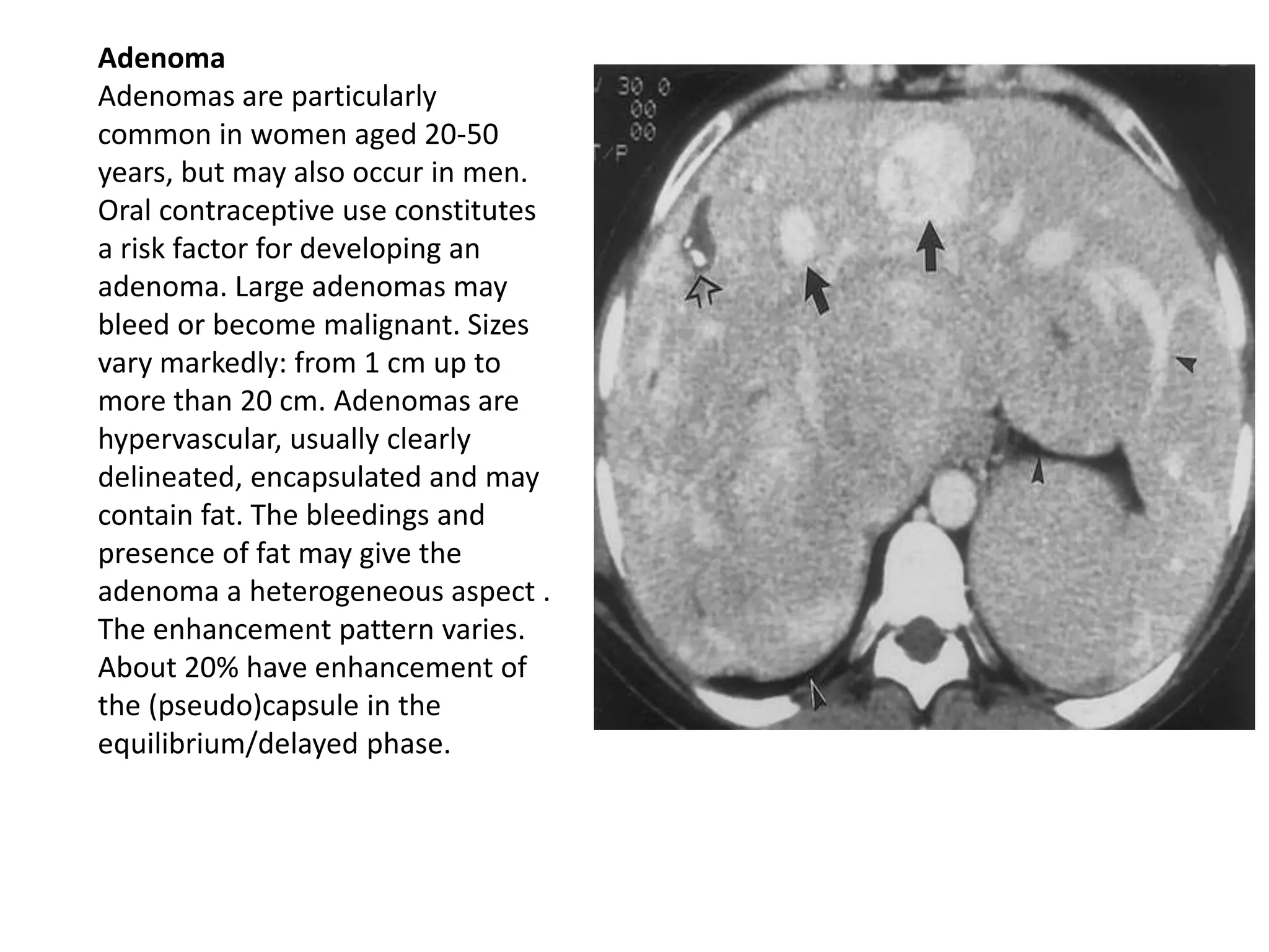 radiological anatomy of liver segments (1).pptx