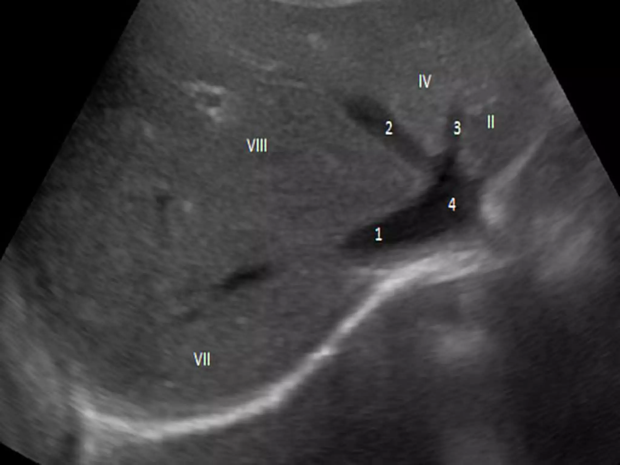 radiological anatomy of liver segments (1).pptx