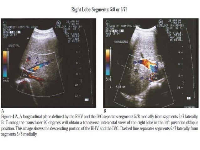 Radiological Anatomy Of Liver Segments 1pptx