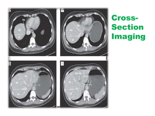 radiological anatomy of liver segments (1).pptx