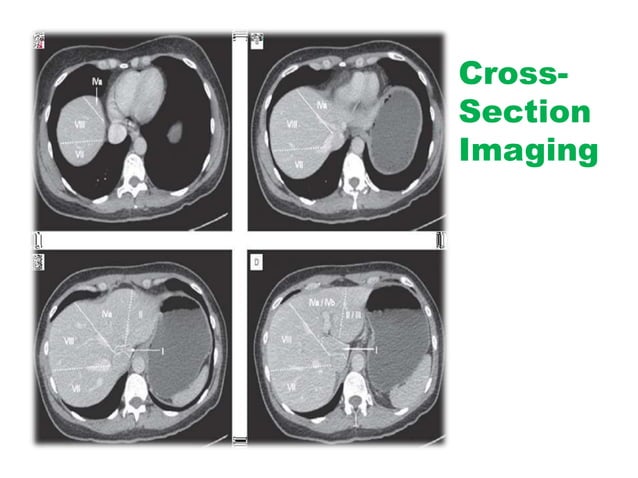 Radiological Anatomy Of Liver Segments 1pptx