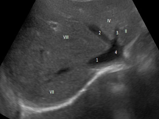 radiological anatomy of liver segments (1).pptx | Endocrine and ...