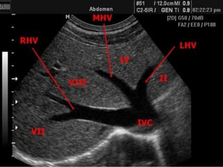 radiological anatomy of liver segments (1).pptx