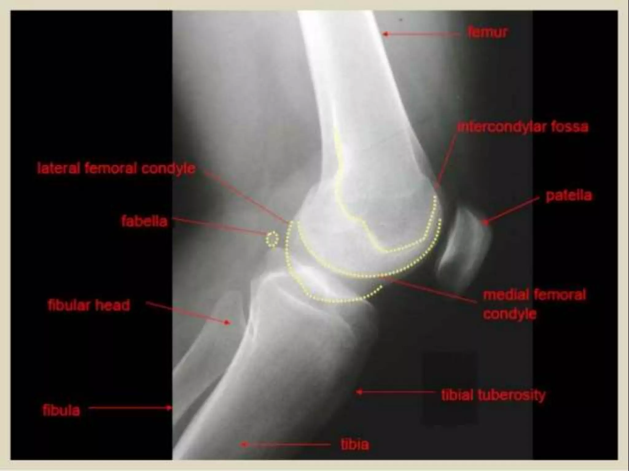 Radiological anatomy of lower limb | PPTX
