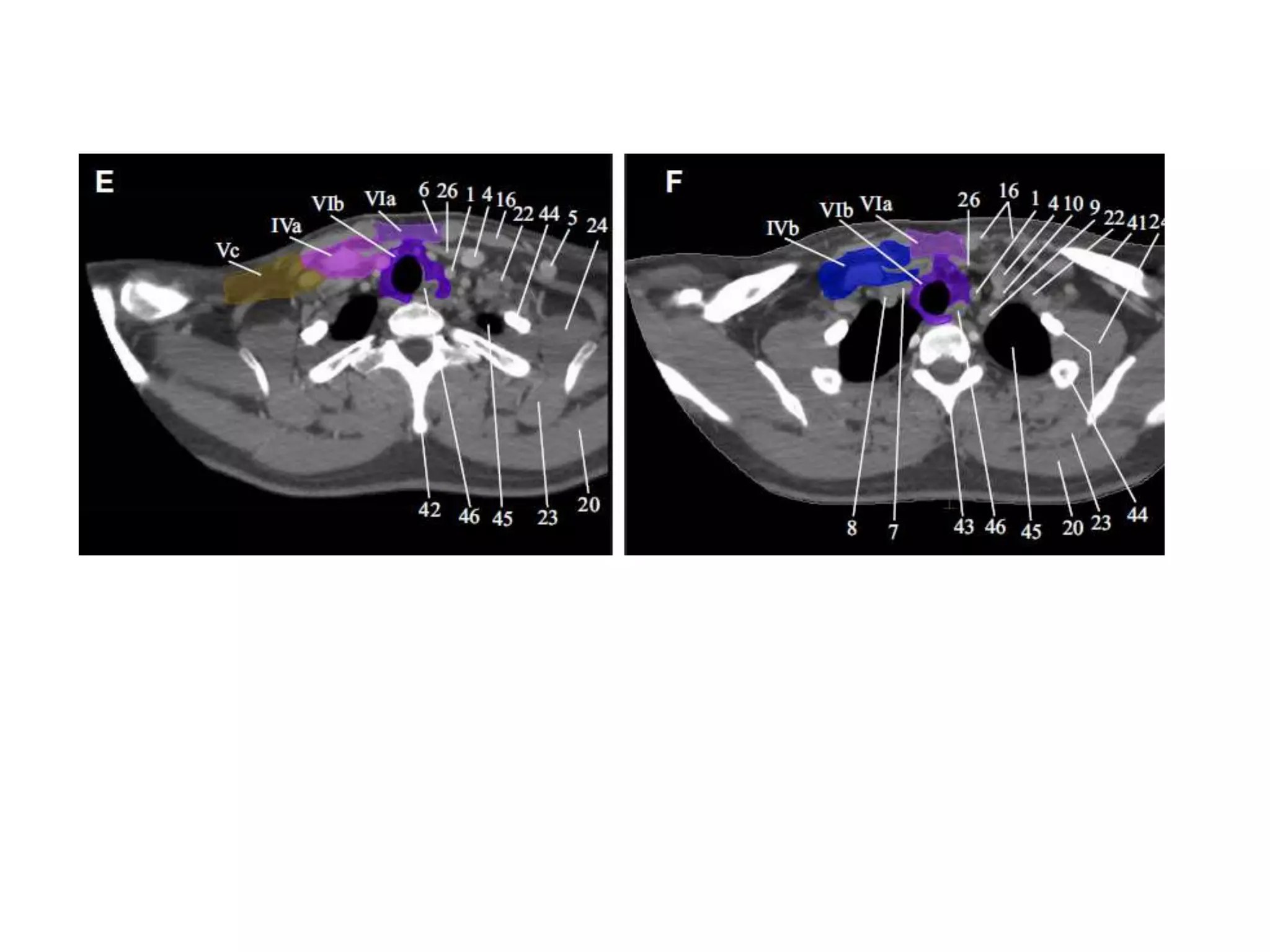 Radiological anatomy of lymph node | PPTX