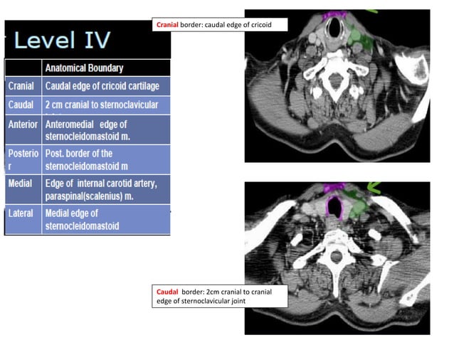 Radiological anatomy of lymph node | PPTX | Ear, Nose and Throat ...
