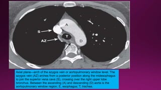 Radiological anatomy of mediastinum | PPTX