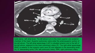Radiological anatomy of mediastinum | PPTX