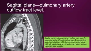 Radiological anatomy of mediastinum | PPTX