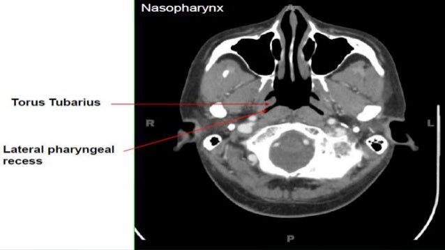 Radiological anatomy of neck