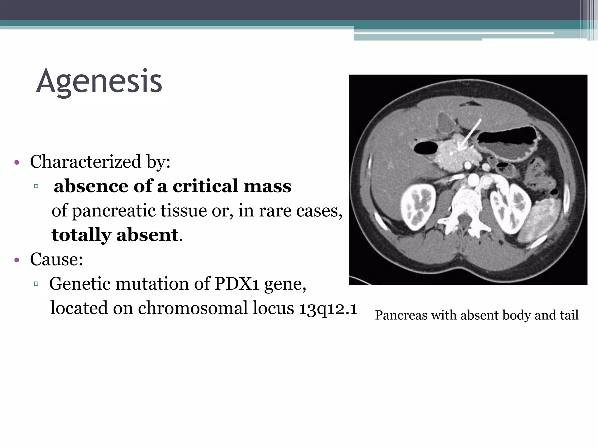 Radiological anatomy of pancreas and spleen | PPTX