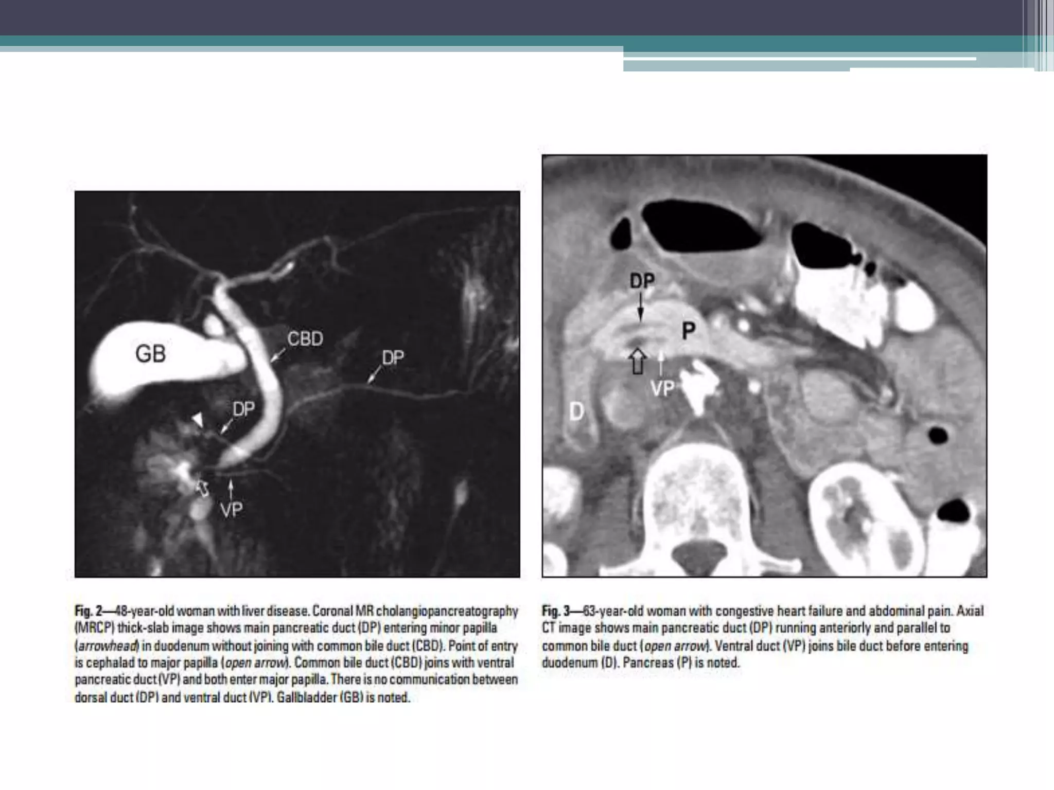 Radiological anatomy of pancreas and spleen | PPTX