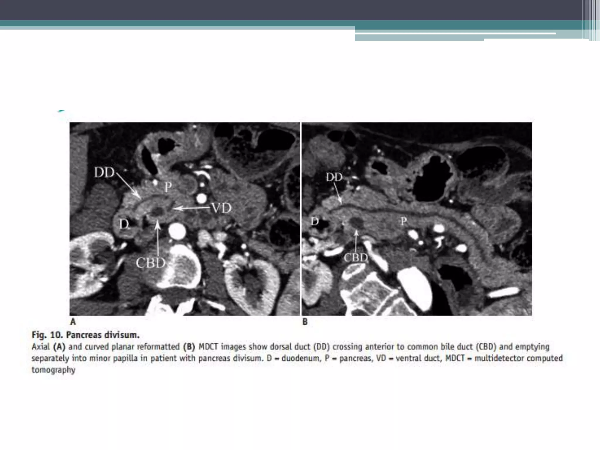 Radiological anatomy of pancreas and spleen | PPTX