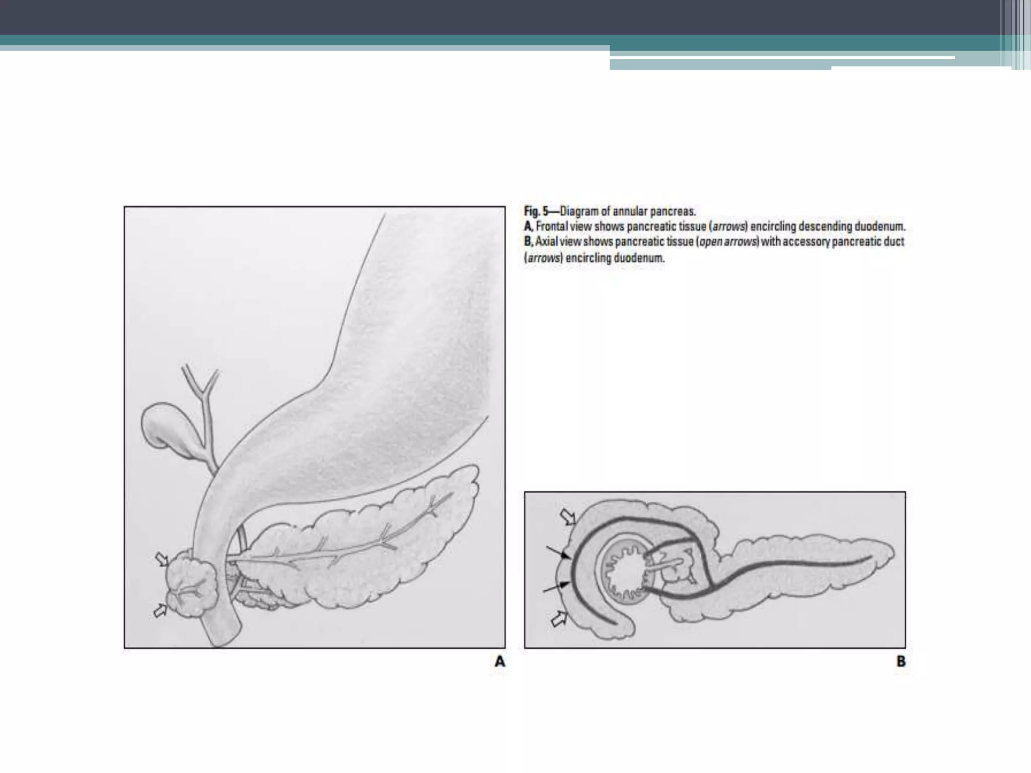 Radiological anatomy of pancreas and spleen | PPTX