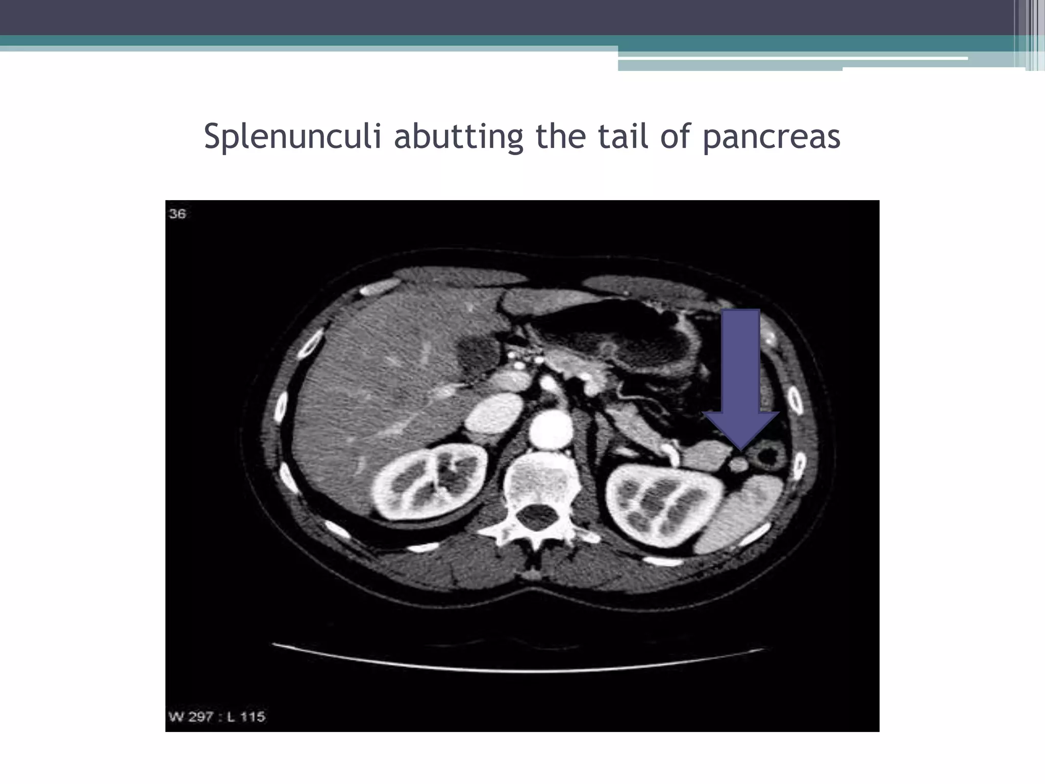 Radiological anatomy of pancreas and spleen | PPTX