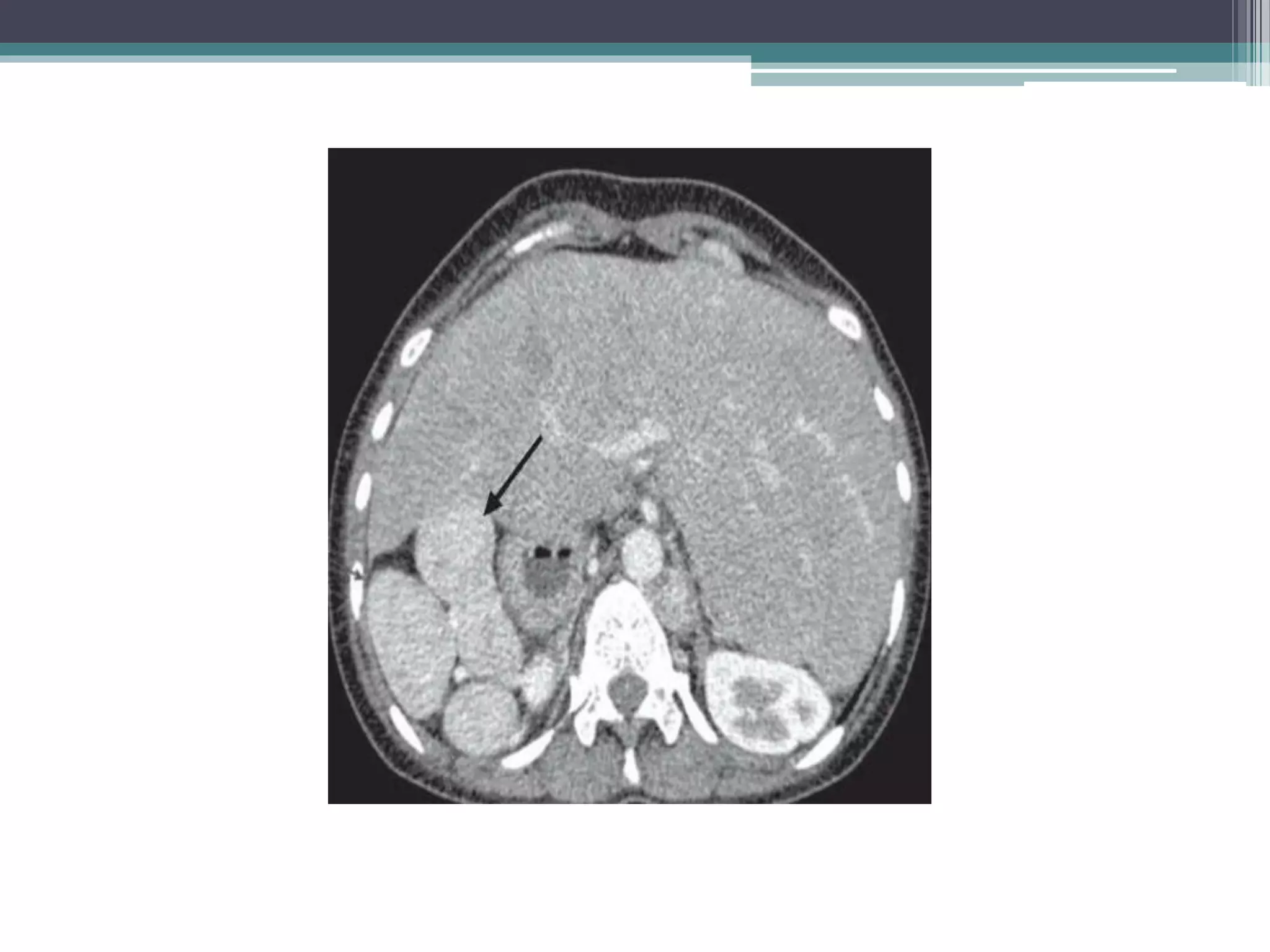 Radiological anatomy of pancreas and spleen | PPTX