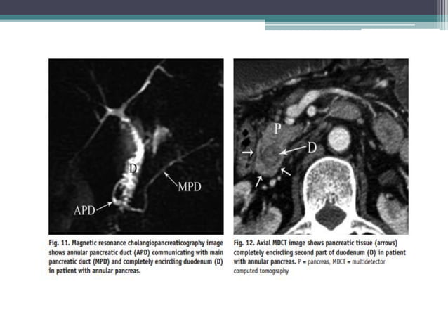 Radiological anatomy of pancreas and spleen | PPTX | Pregnancy ...