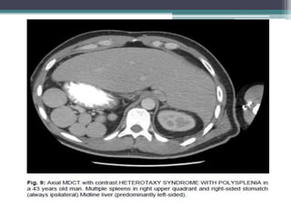 Radiological anatomy of pancreas and spleen | PPTX