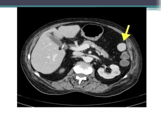 Radiological anatomy of pancreas and spleen | PPTX