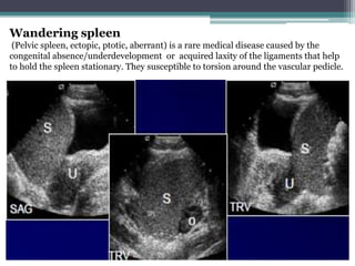 Radiological anatomy of pancreas and spleen | PPTX