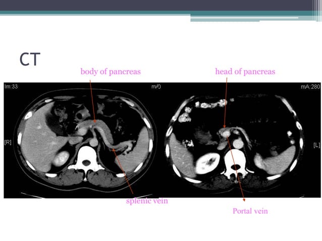 Radiological anatomy of pancreas and spleen | PPTX | Pregnancy ...