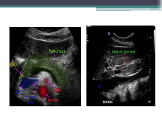Annular Pancreas Ultrasound
