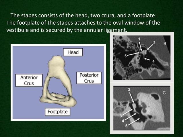 Radiological anatomy of_temporal_bone[1] | PPTX