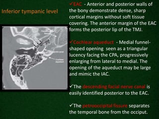 Radiological anatomy of_temporal_bone[1] | PPTX
