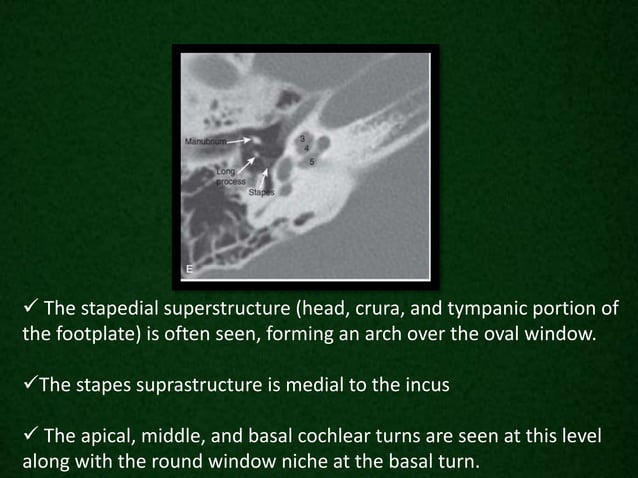 Radiological anatomy of_temporal_bone[1] | PPTX