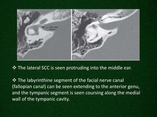 Radiological anatomy of_temporal_bone[1] | PPTX
