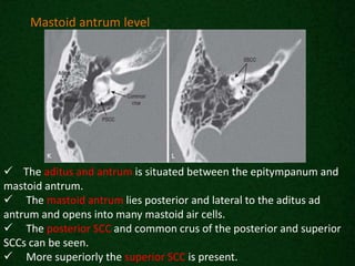 Radiological anatomy of_temporal_bone[1] | PPTX