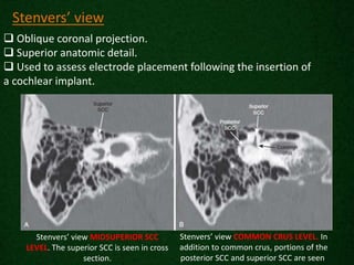 Radiological anatomy of_temporal_bone[1] | PPTX