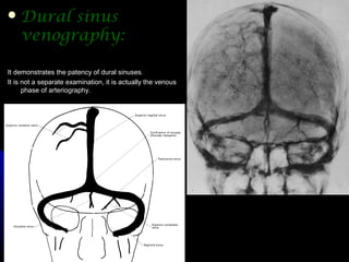 Radiological anatomy of the brain | PPT