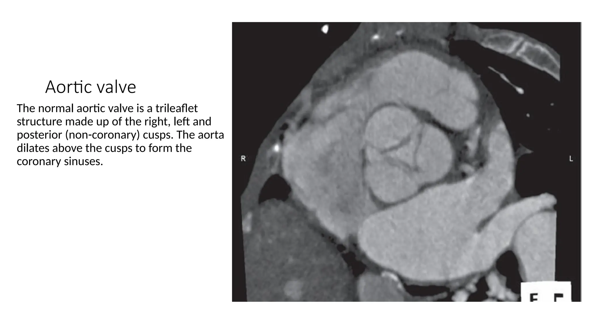Radiological Anatomy Of the heart and great vessels.pptx