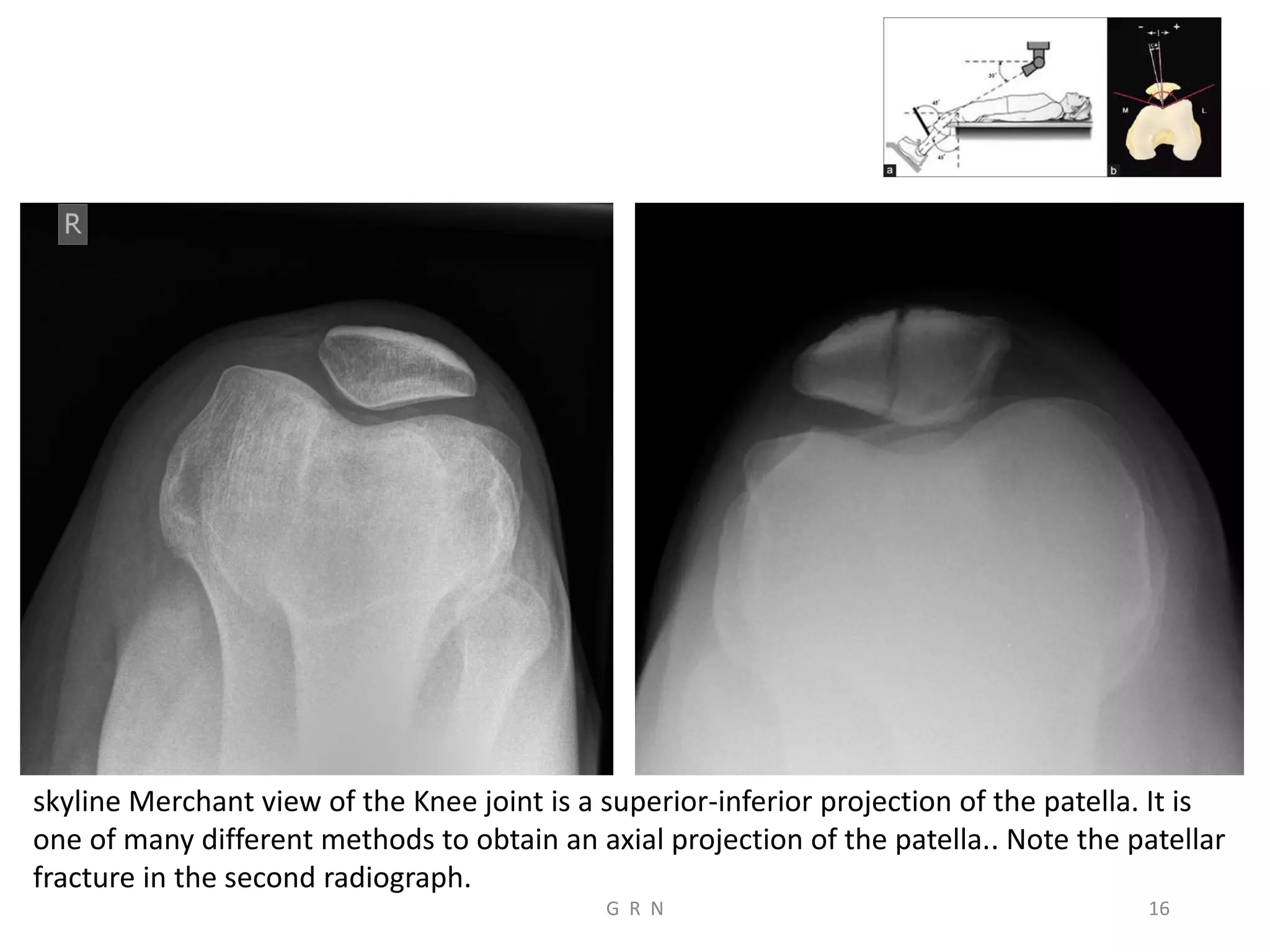 Radiological anatomy of the lower limb r | PDF