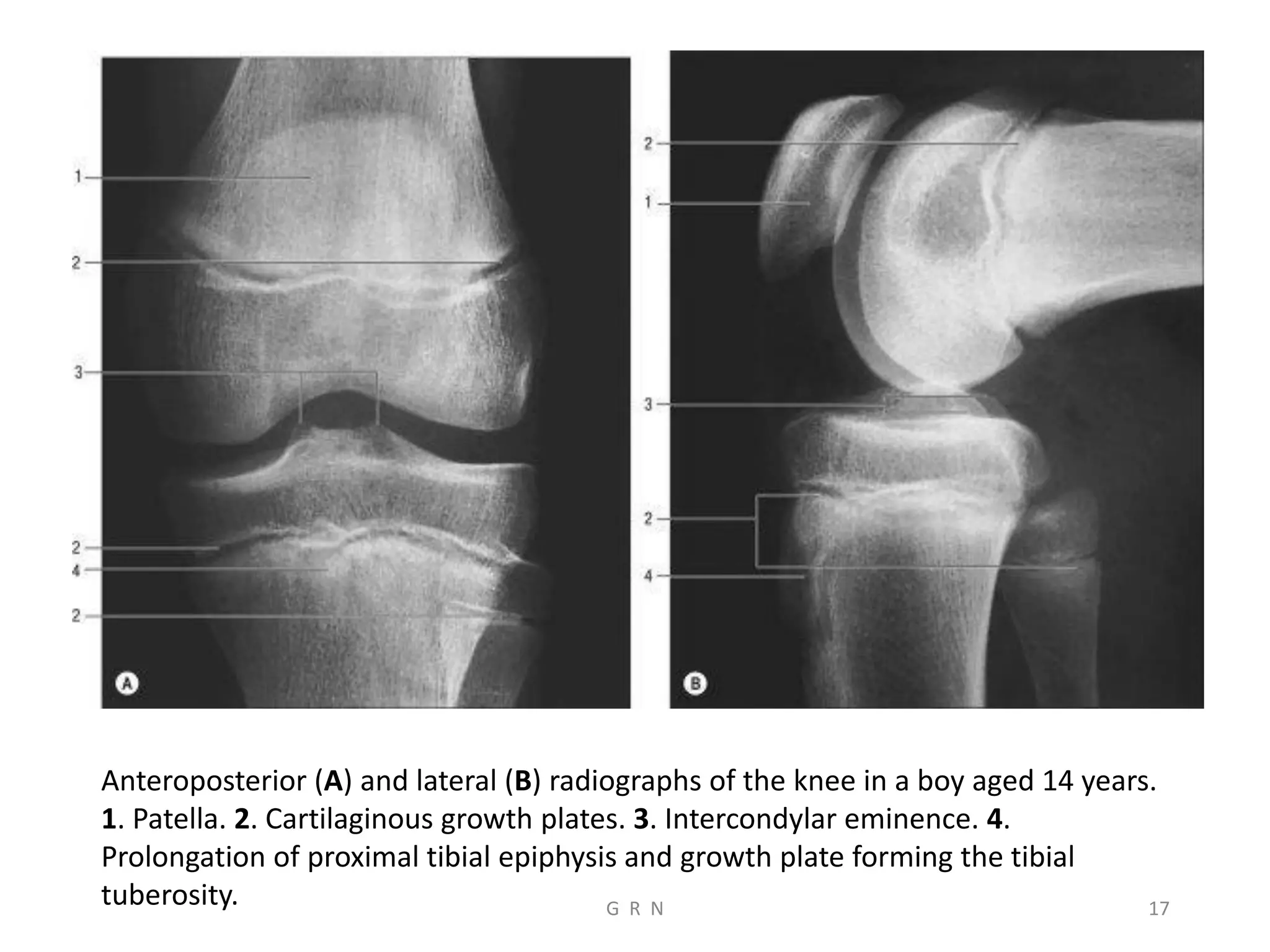 Radiological anatomy of the lower limb r | PDF