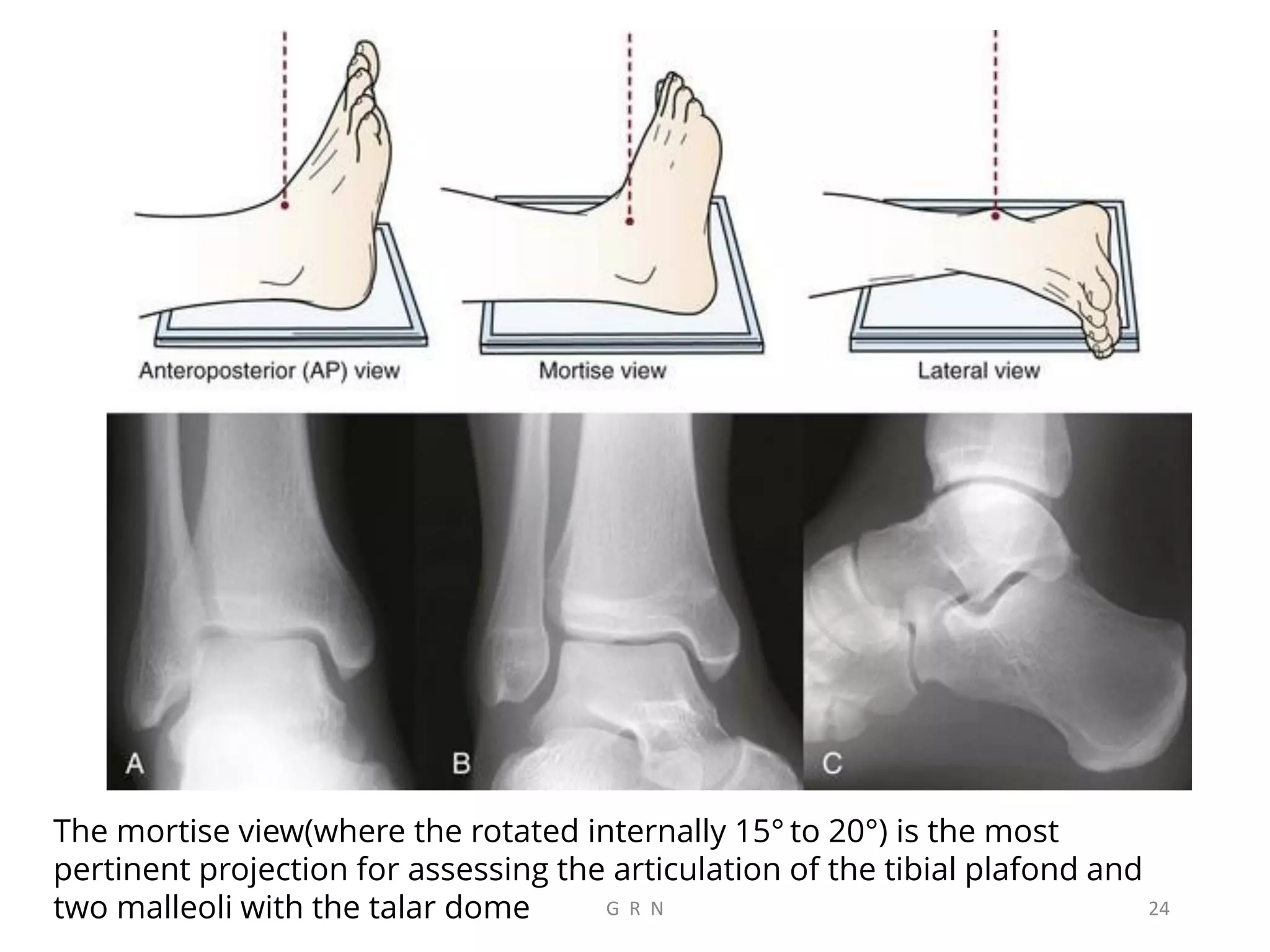 Radiological anatomy of the lower limb r | PDF