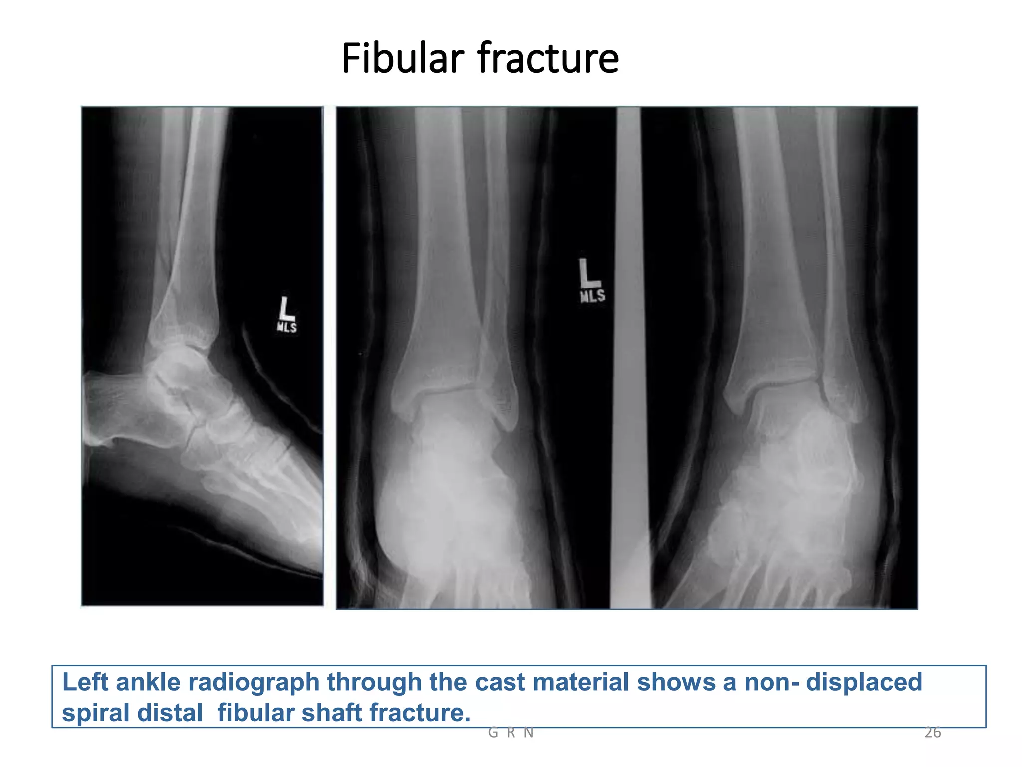 Radiological anatomy of the lower limb r | PDF