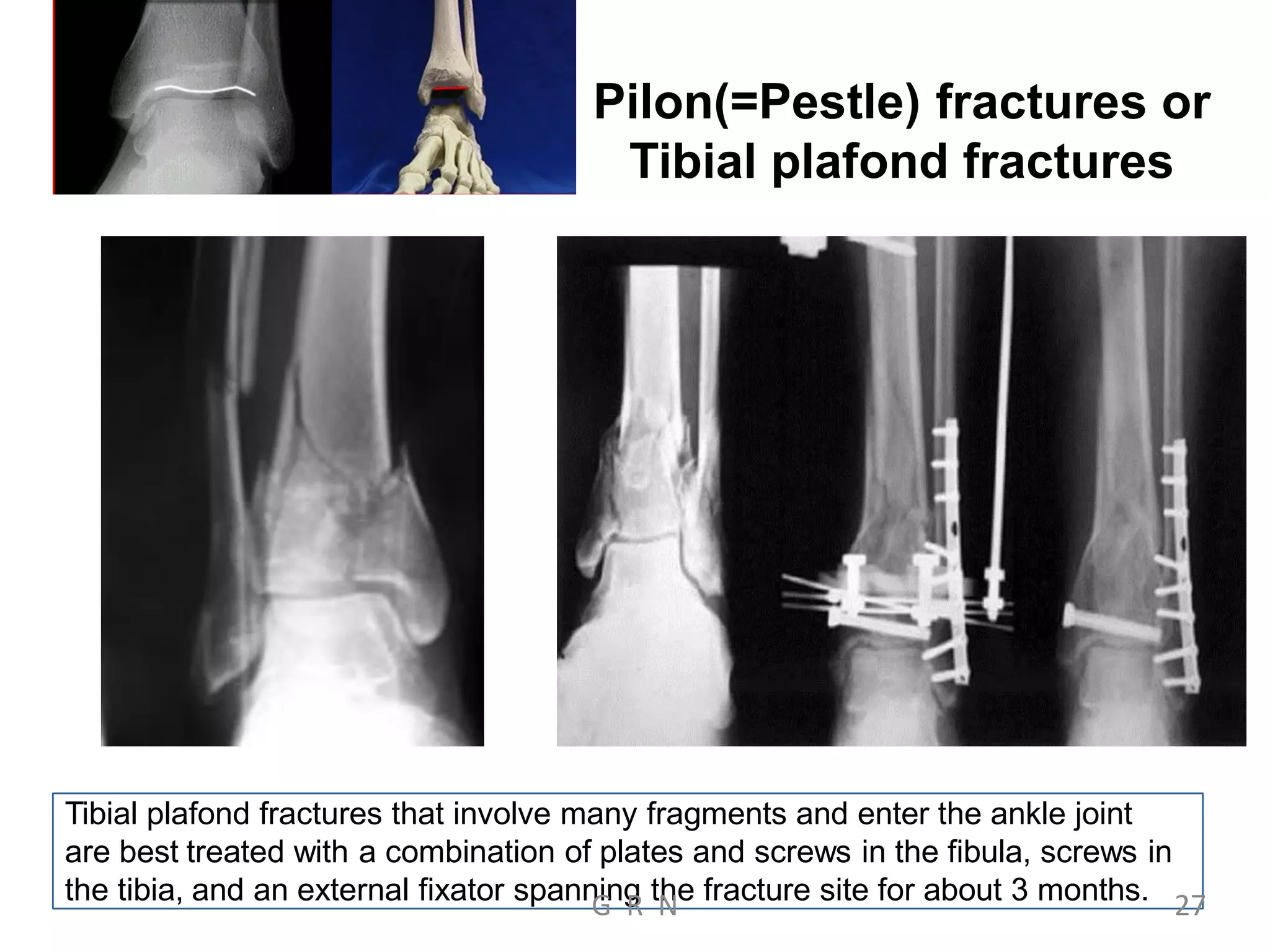 Radiological anatomy of the lower limb r | PDF