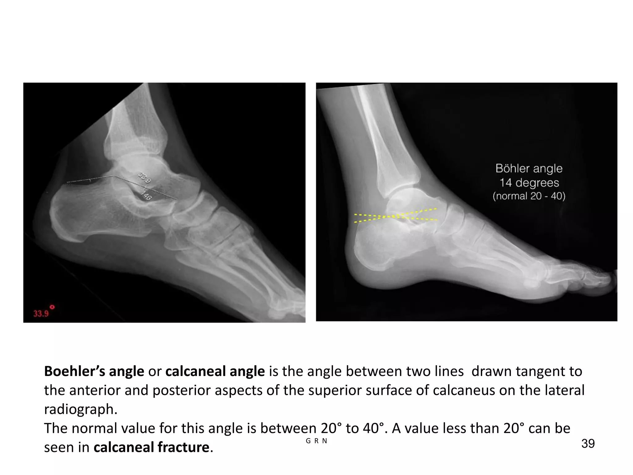 Radiological anatomy of the lower limb r | PDF