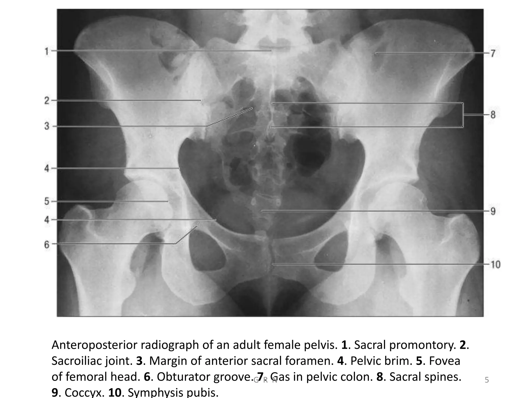 Radiological anatomy of the lower limb r | PDF