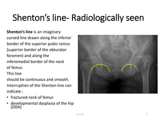 Radiological anatomy of the lower limb r | PDF