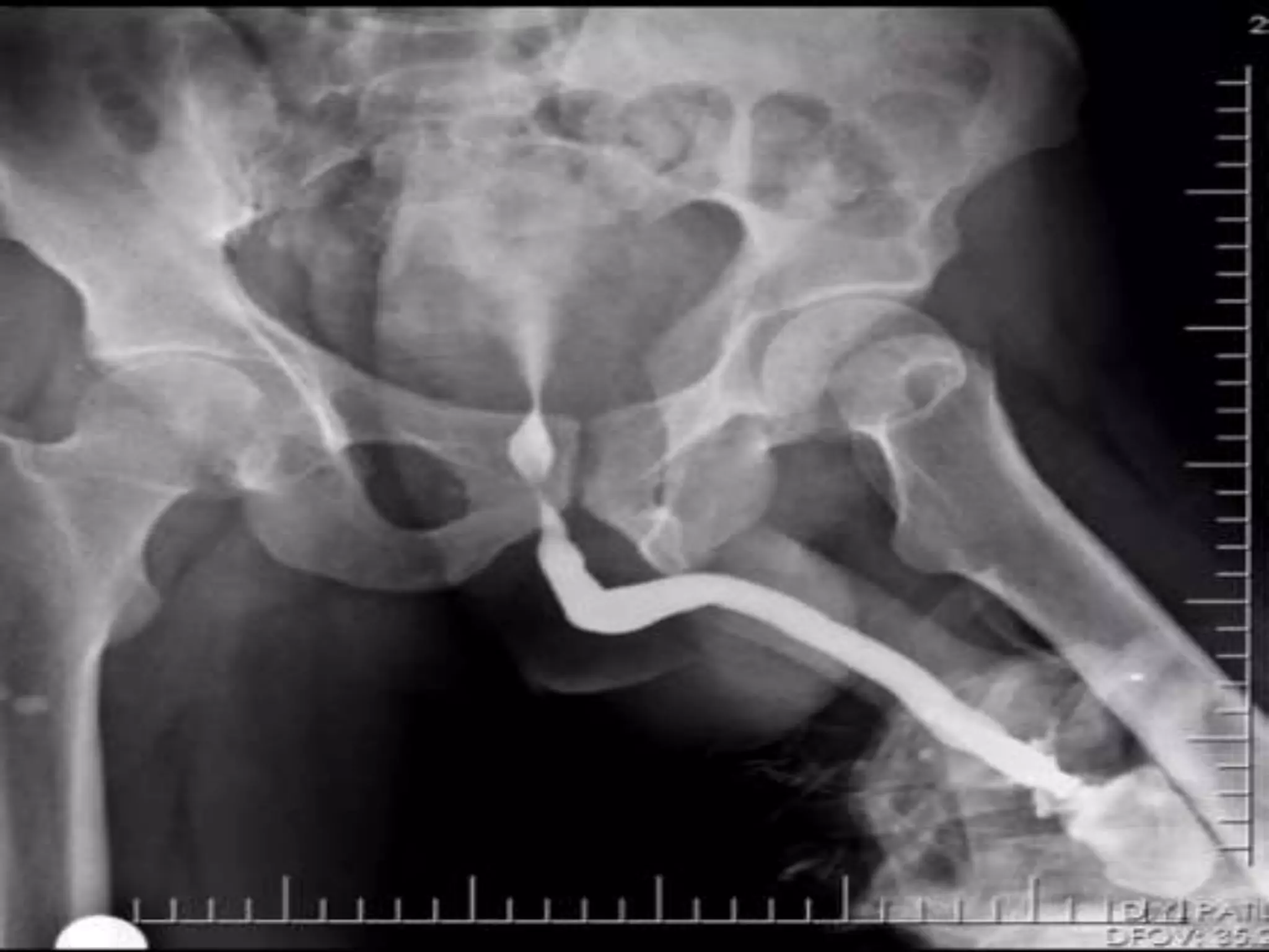 Radiological anatomy of the male urethra and techniques of imaging | PPTX