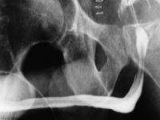 Radiological anatomy of the male urethra and techniques of imaging ...