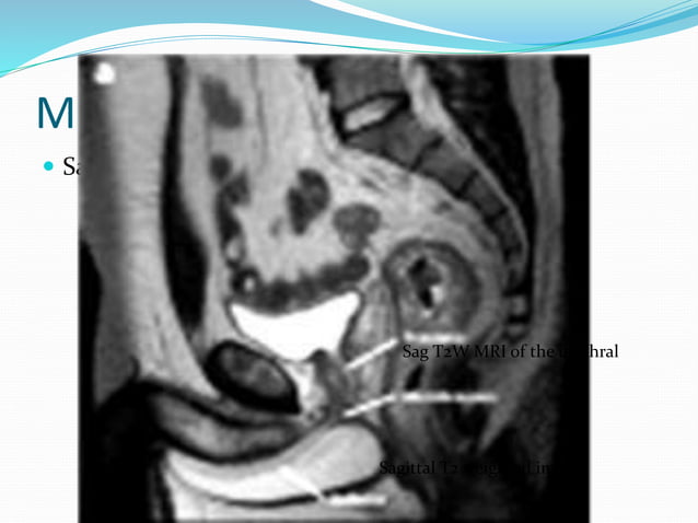 Radiological anatomy of the male urethra and techniques of imaging ...