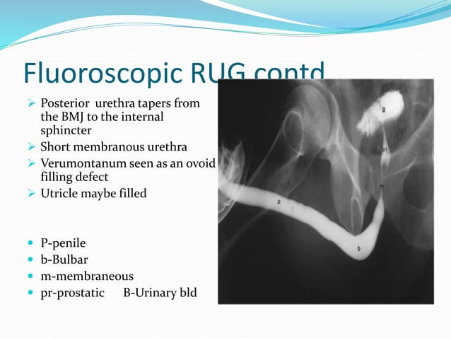 Radiological anatomy of the male urethra and techniques of imaging | PPT