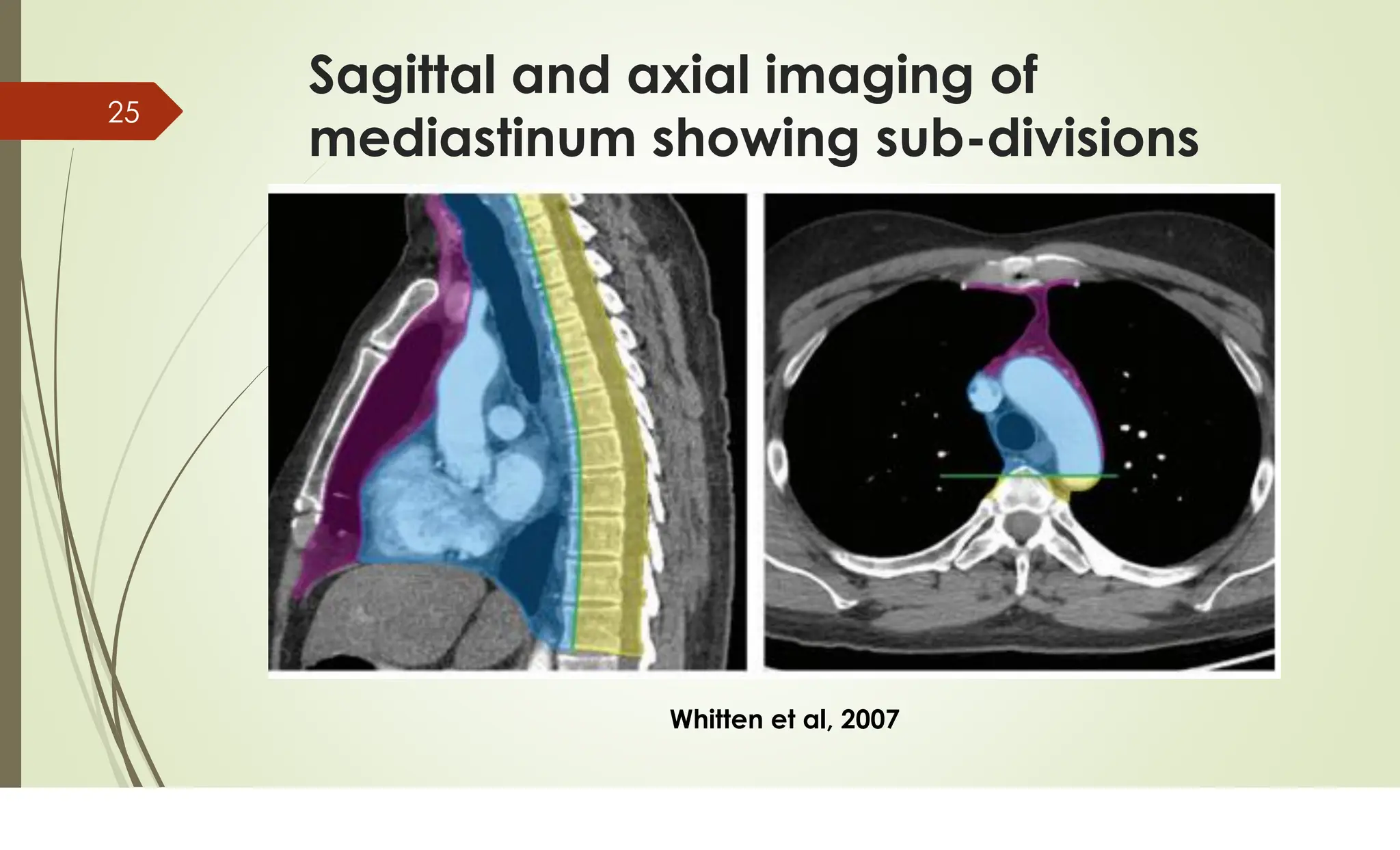 RADIOLOGICAL ANATOMY OF THE MEDIASTINUM.PDF