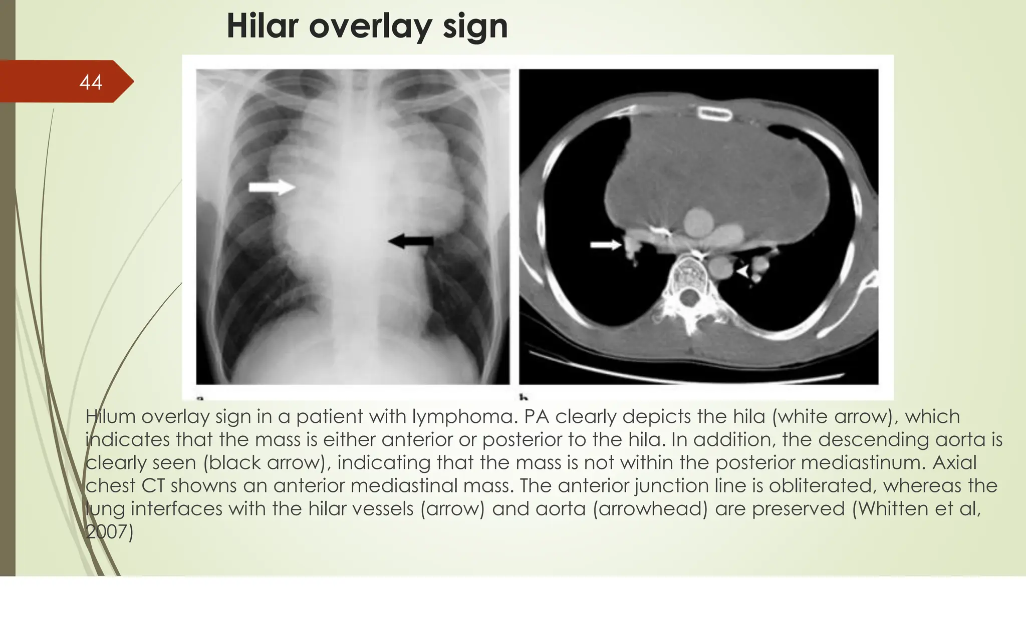 RADIOLOGICAL ANATOMY OF THE MEDIASTINUM.PDF